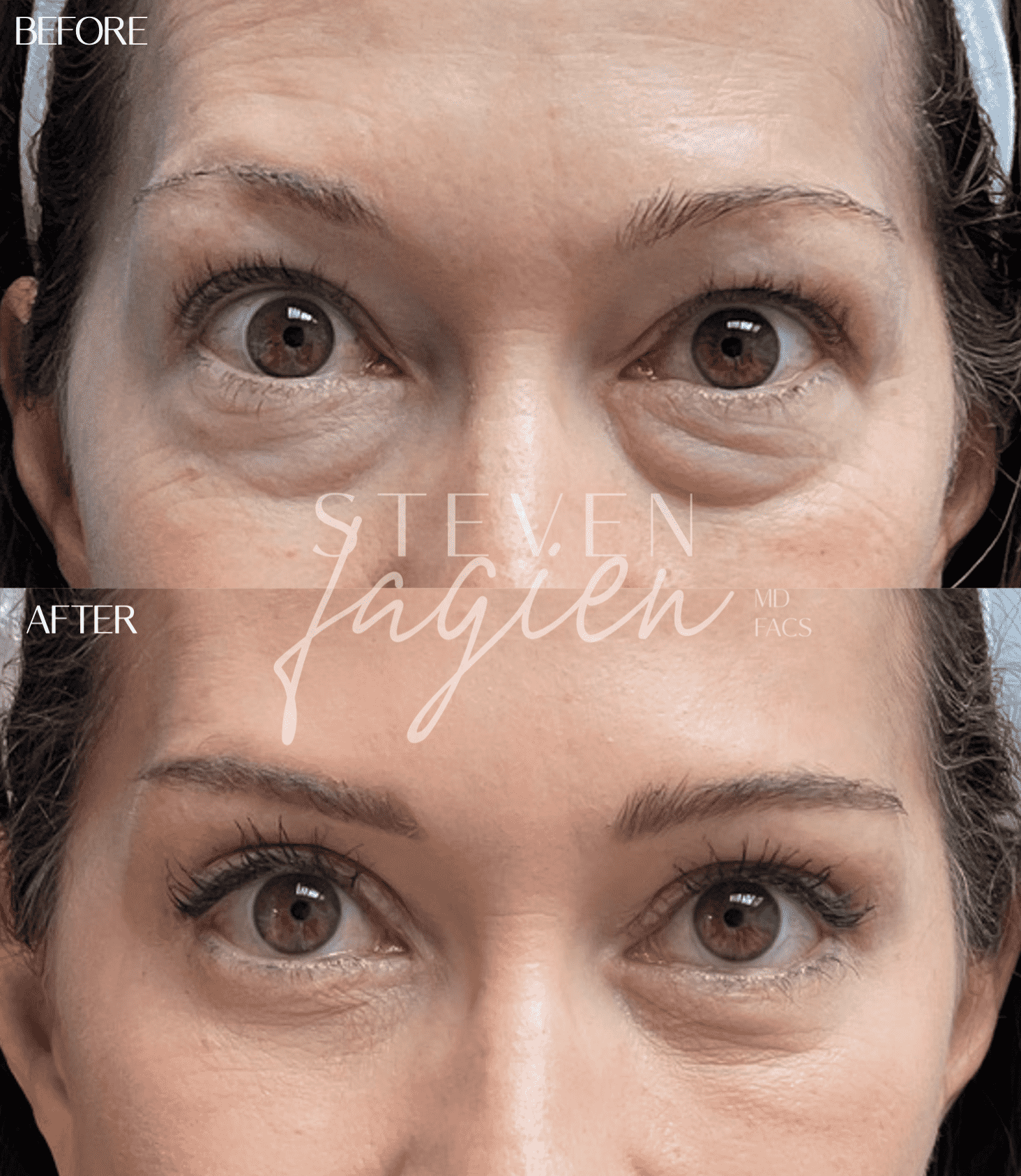 Upper + Lower Blepharoplasty - Gallery Fagien - Dr. Fagien & Dr. Vaca ...