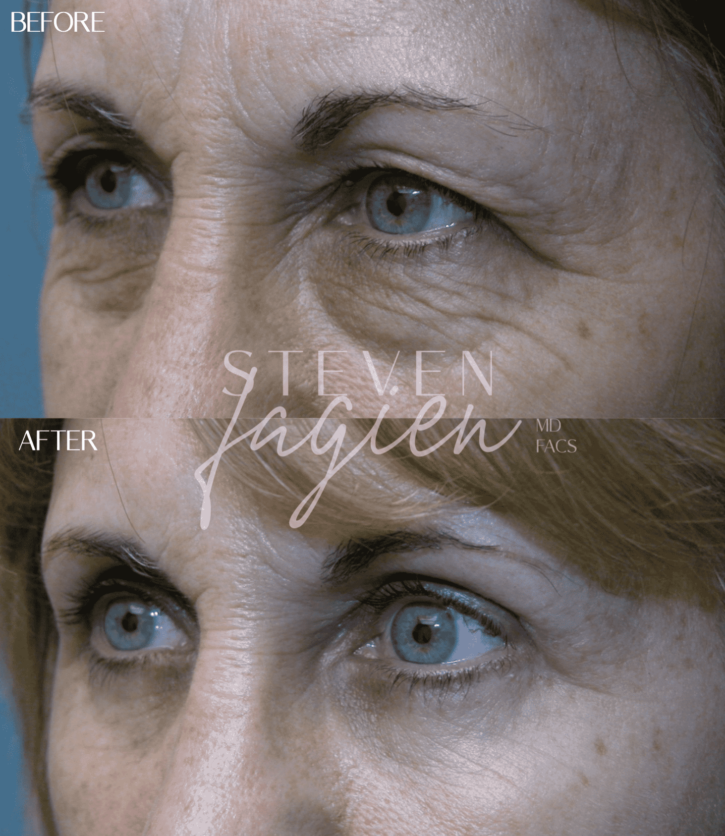 Upper + Lower Blepharoplasty - Gallery Fagien - Dr. Fagien & Dr. Vaca ...