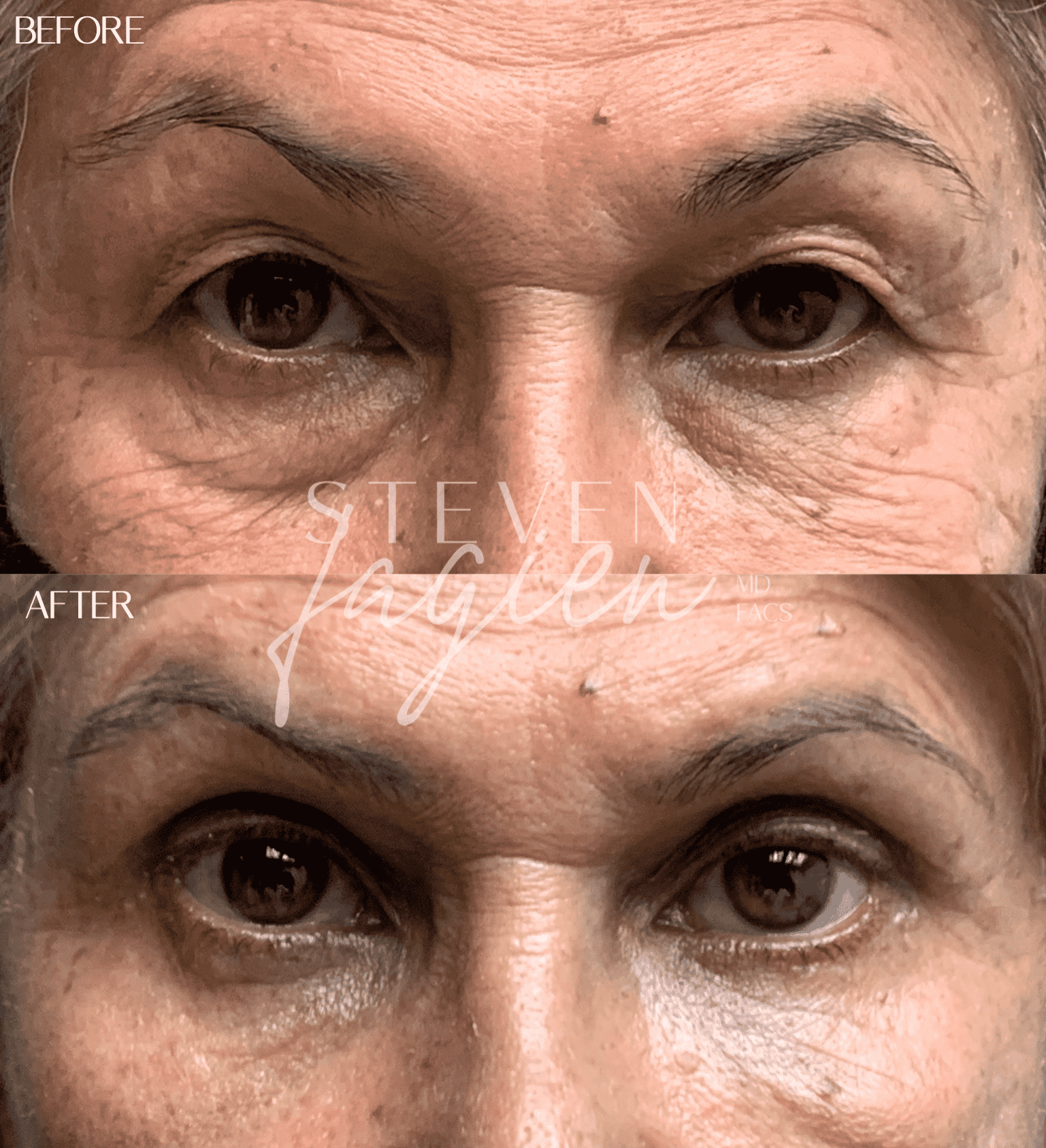 Upper + Lower Blepharoplasty - Gallery Fagien - Dr. Fagien & Dr. Vaca ...