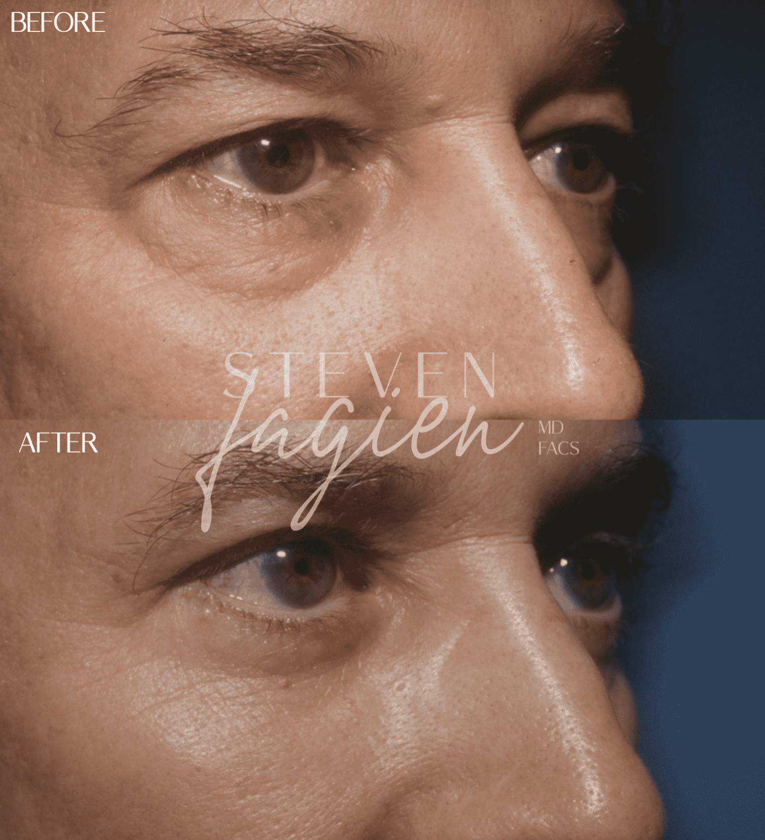 Upper + Lower Blepharoplasty - Gallery Fagien - Dr. Fagien & Dr. Vaca ...