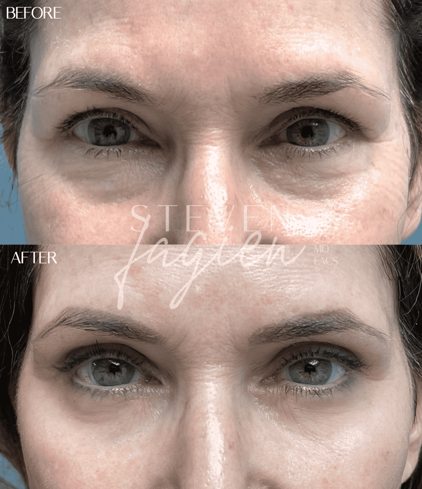 Upper + Lower Blepharoplasty - Gallery Fagien - Dr. Fagien & Dr. Vaca ...