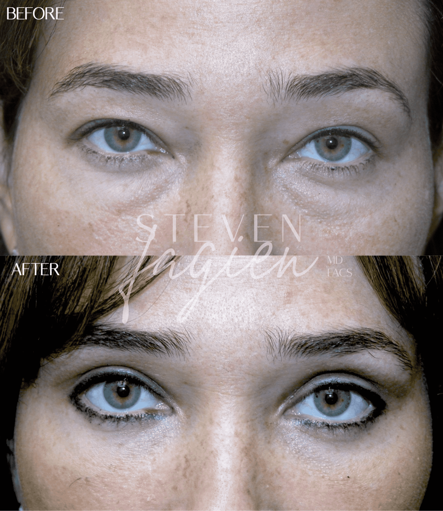 Upper + Lower Blepharoplasty - Gallery Fagien - Dr. Fagien & Dr. Vaca ...